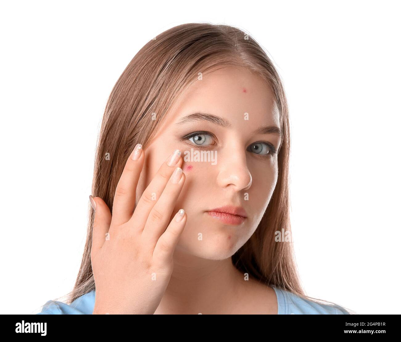 Teenage girl with acne problem on white background Stock Photo - Alamy