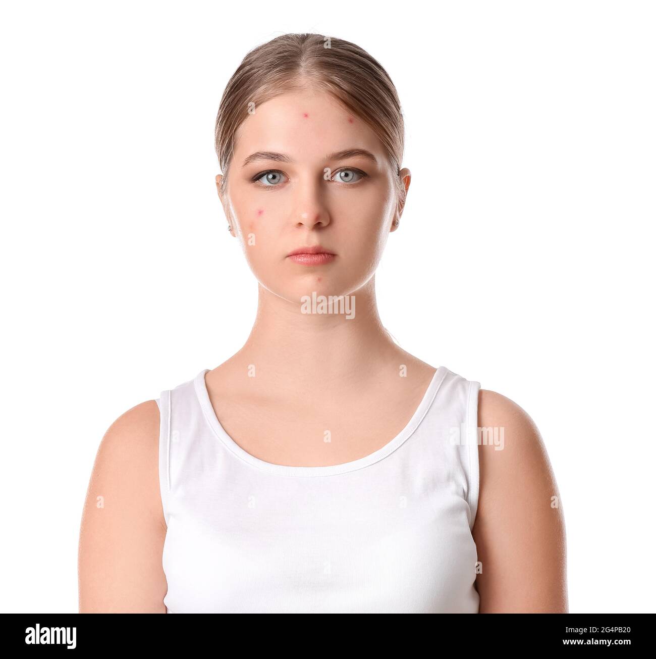 Teenage girl with acne problem on white background Stock Photo - Alamy