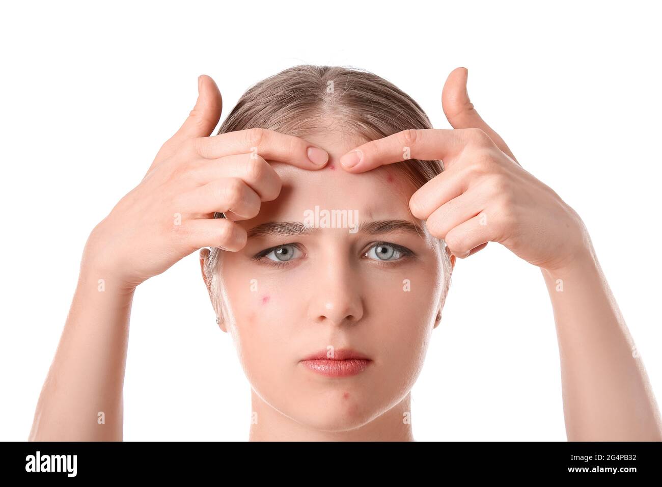 Teenage girl with acne problem on white background Stock Photo - Alamy