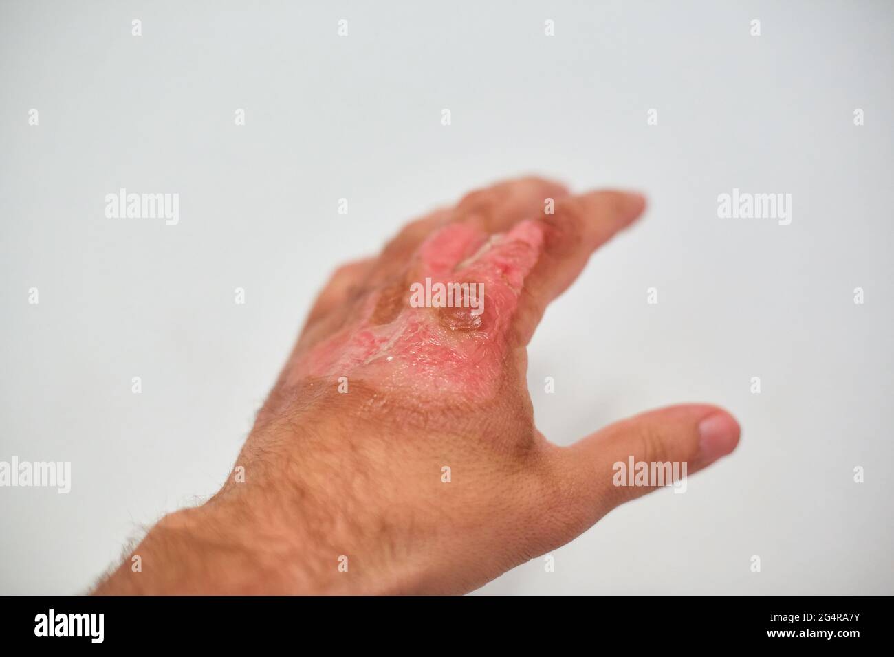 new skin on the hand after a burn, healing burn on the body Stock Photo ...