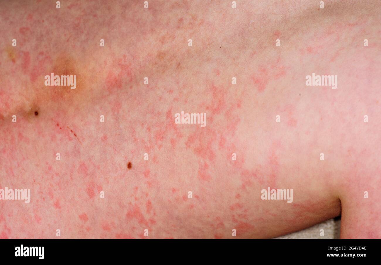 Young person with skin rash Stock Photo - Alamy