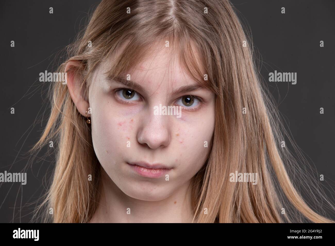 The face of a teenage girl with pimples close-up on a gray background ...