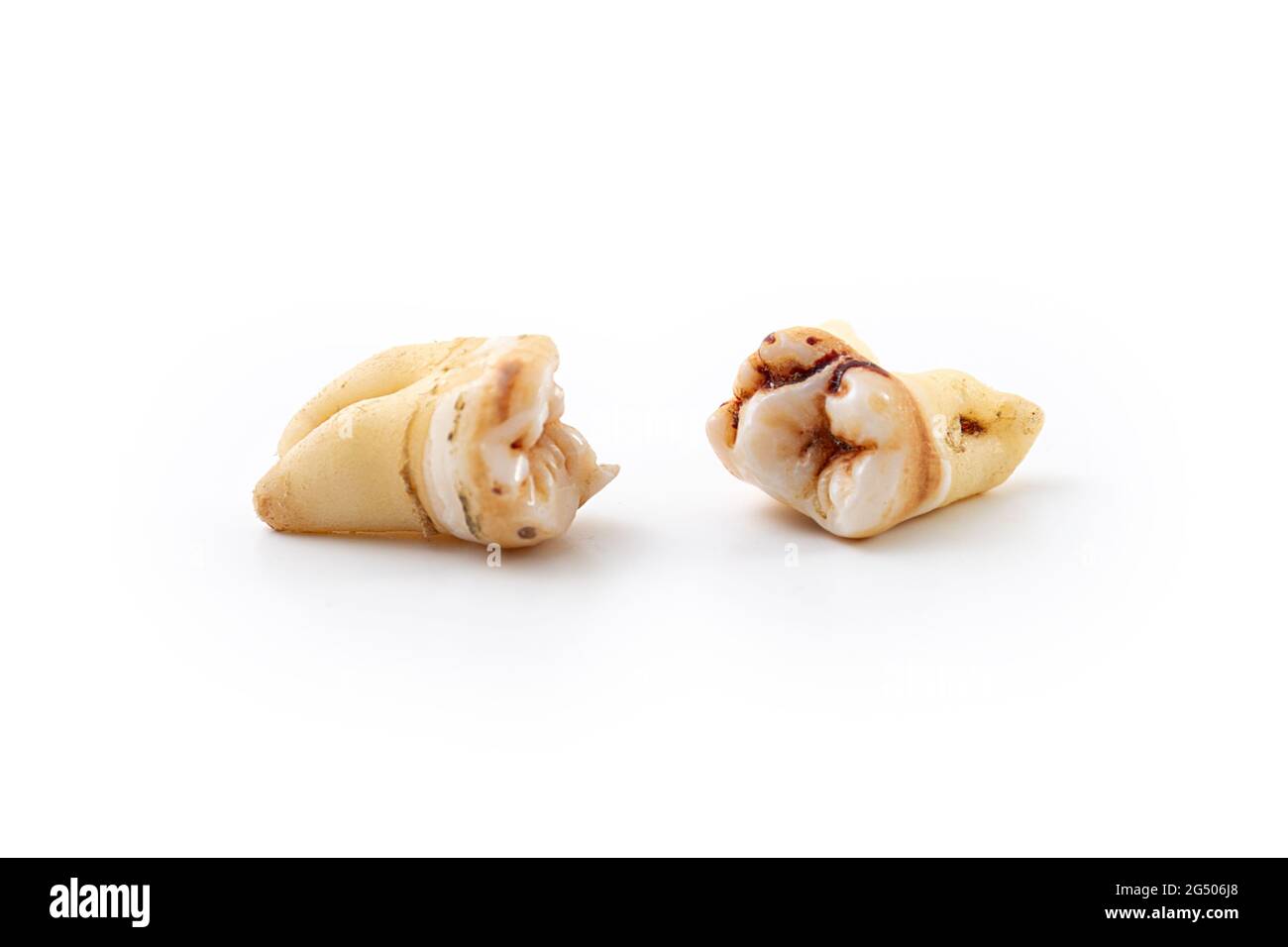 Dental Caries Teeth Decay High Resolution Stock Photography and Images ...