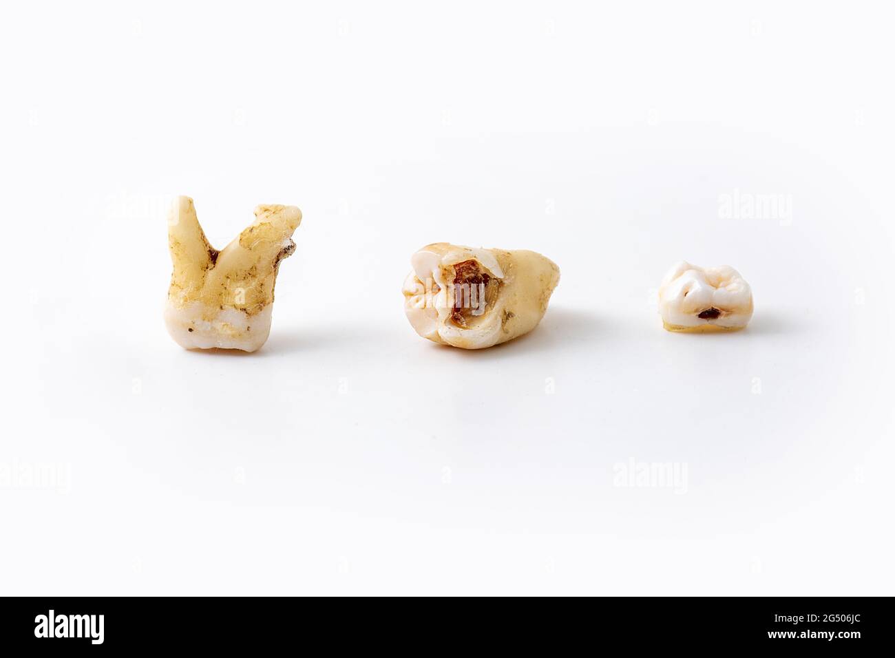 Tooth Cavity Decay High Resolution Stock Photography and Images - Alamy