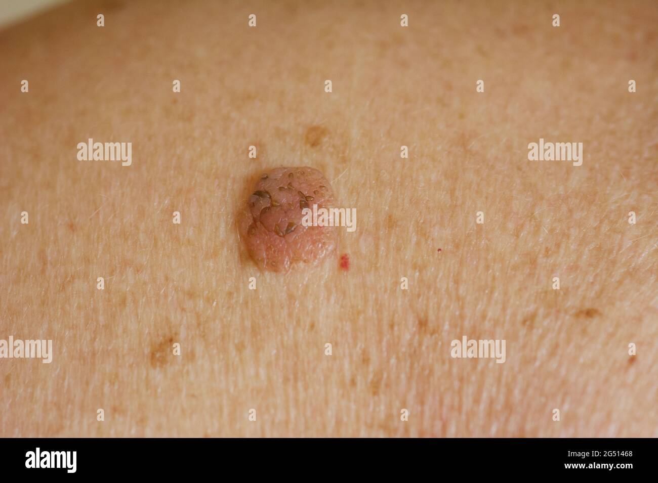 Benign mole hi-res stock photography and images - Alamy