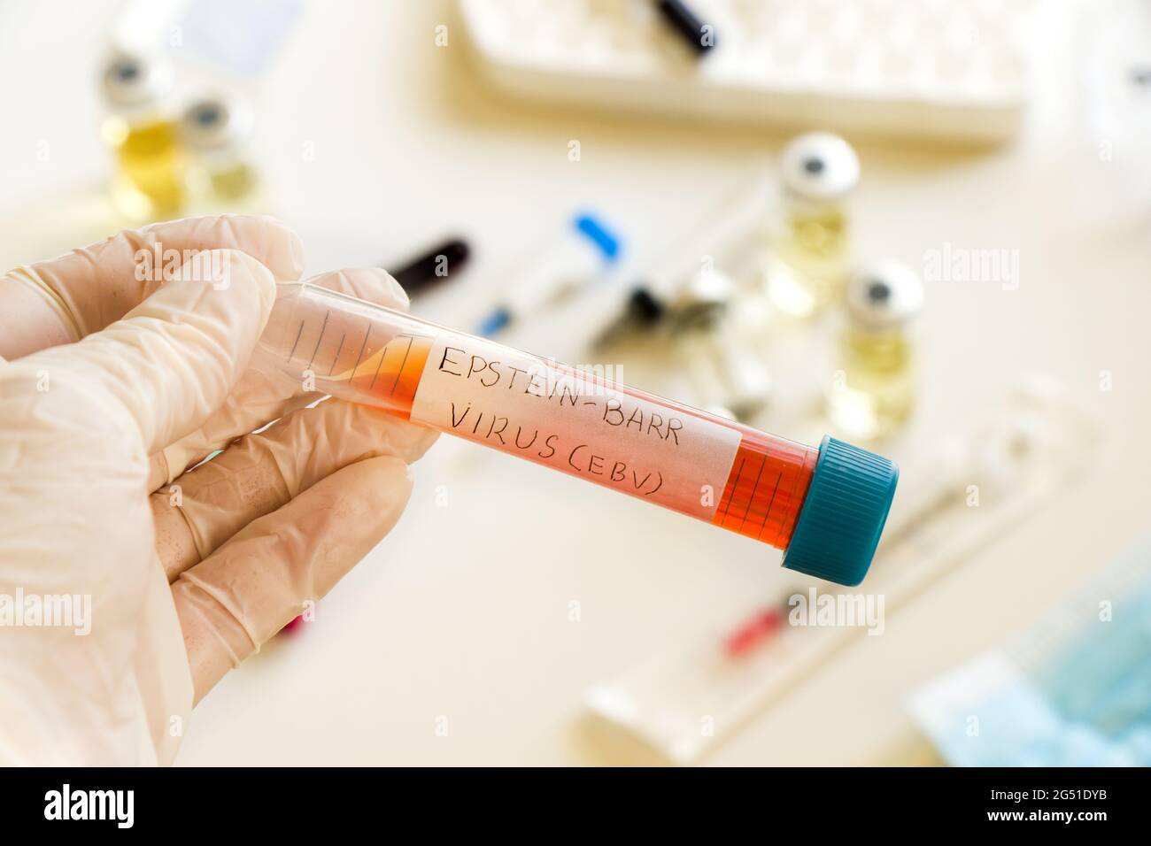 Closeup shot of a gloved hand holding an Epstein-Barr virus blood test ...