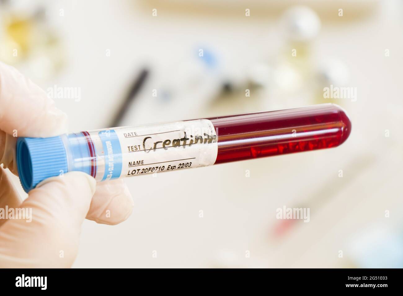 Creatinine hi-res stock photography and images - Alamy