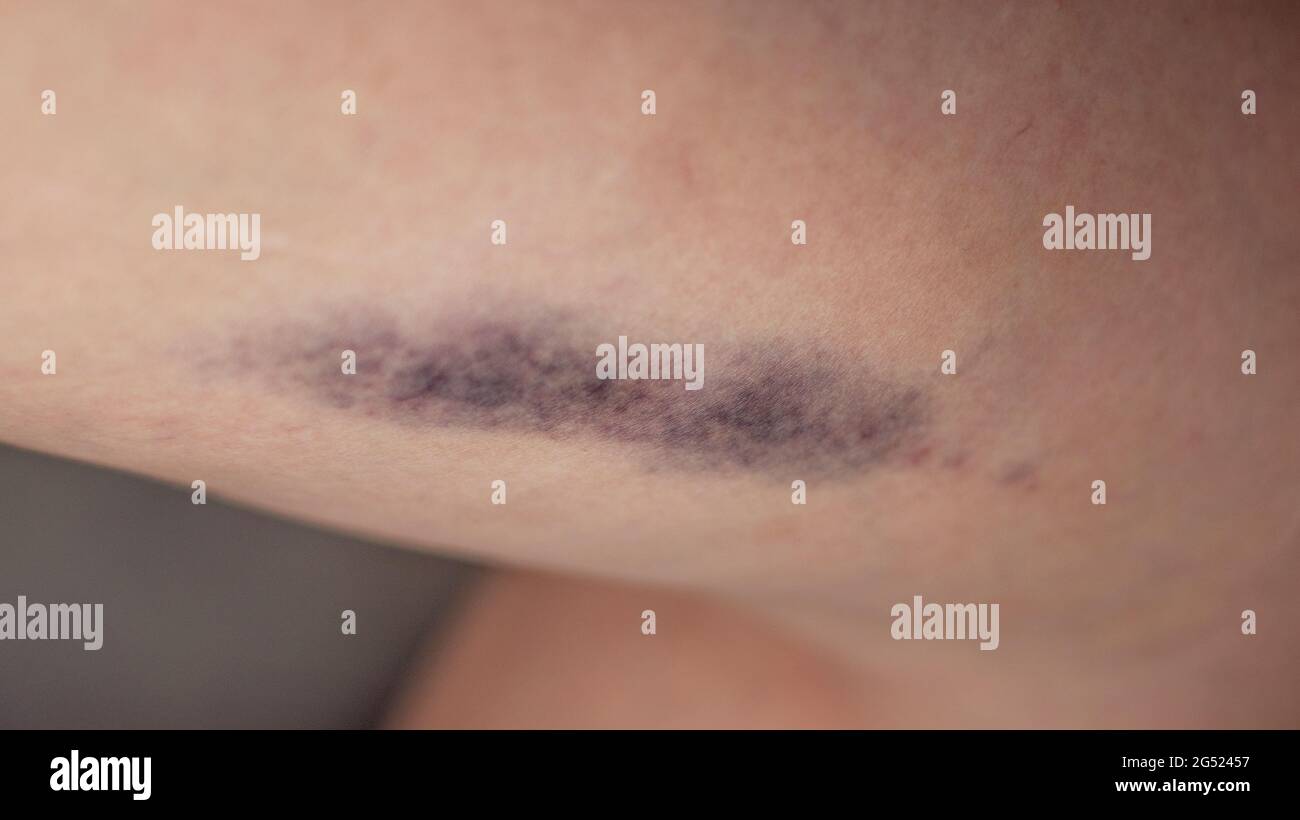 Big bruising on a woman's thigh. Injury to the leg. Domestic violence ...