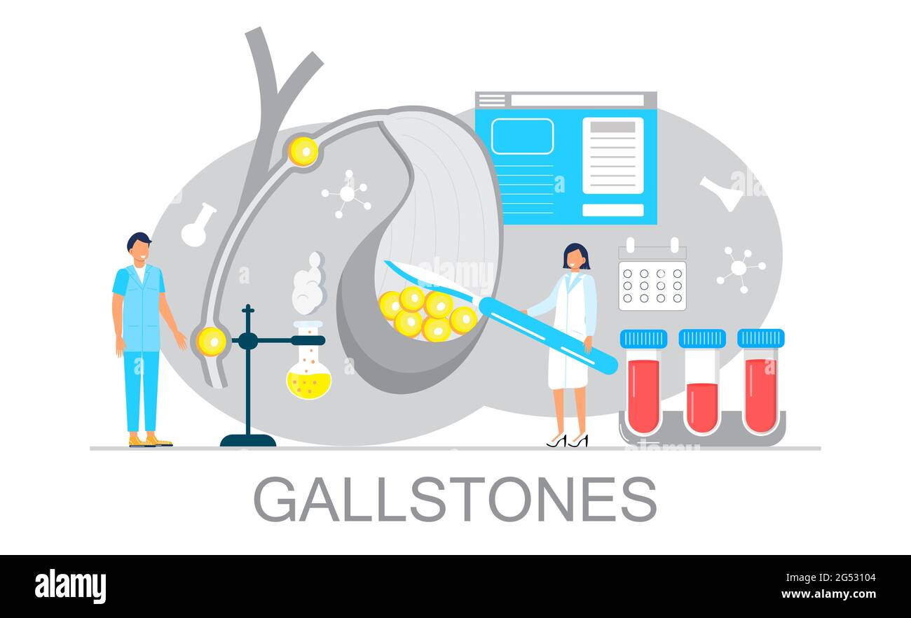 Gallbladder concept vector. Doctors treat gallstones. Biliary ...