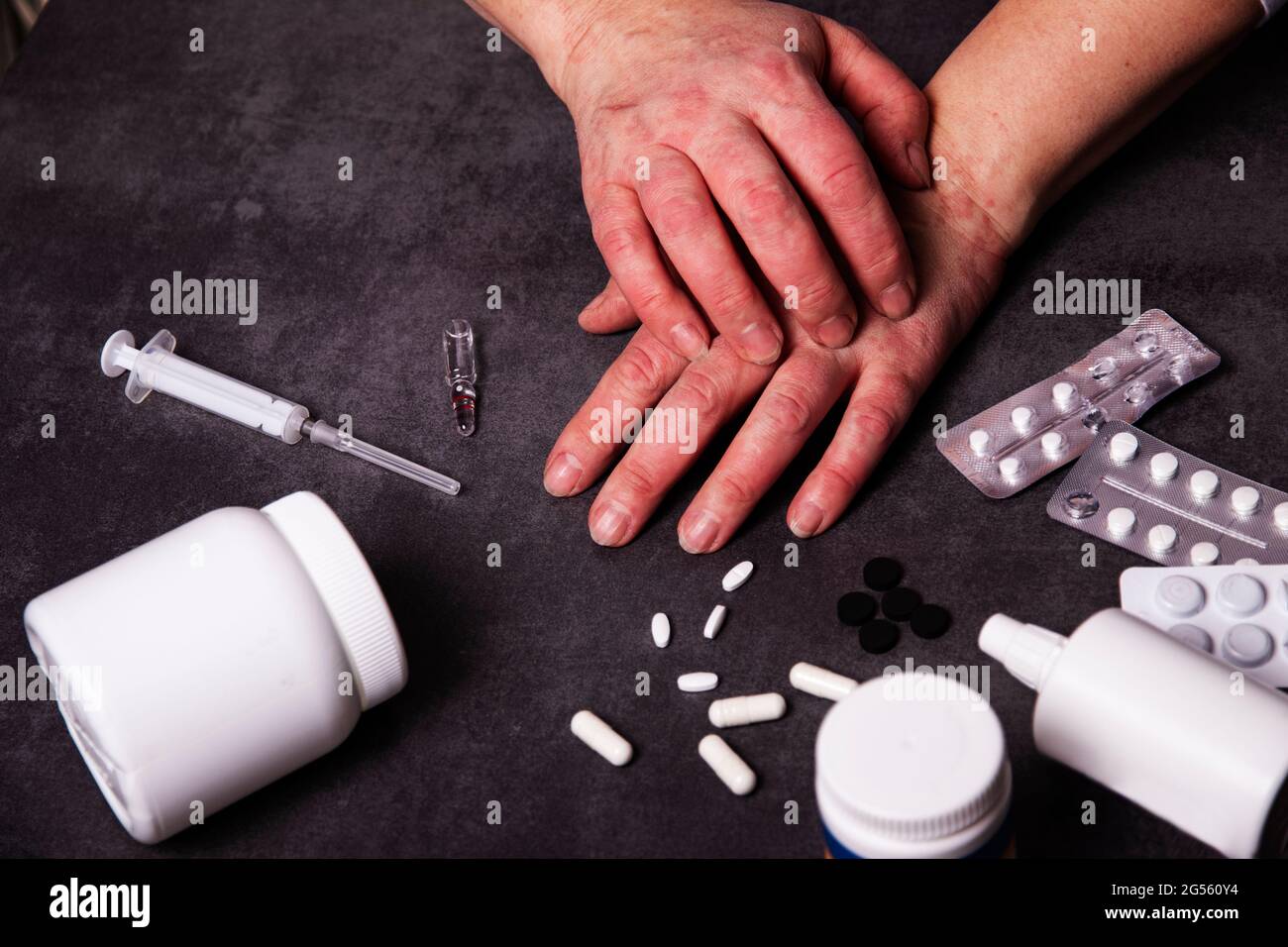 Hands with allergic dermatitis, dermatological problems. Sore skin ...