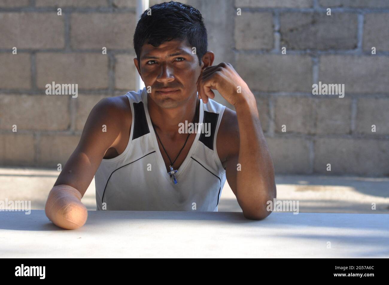 A Central American man who had lost part of his arm in a work-related ...