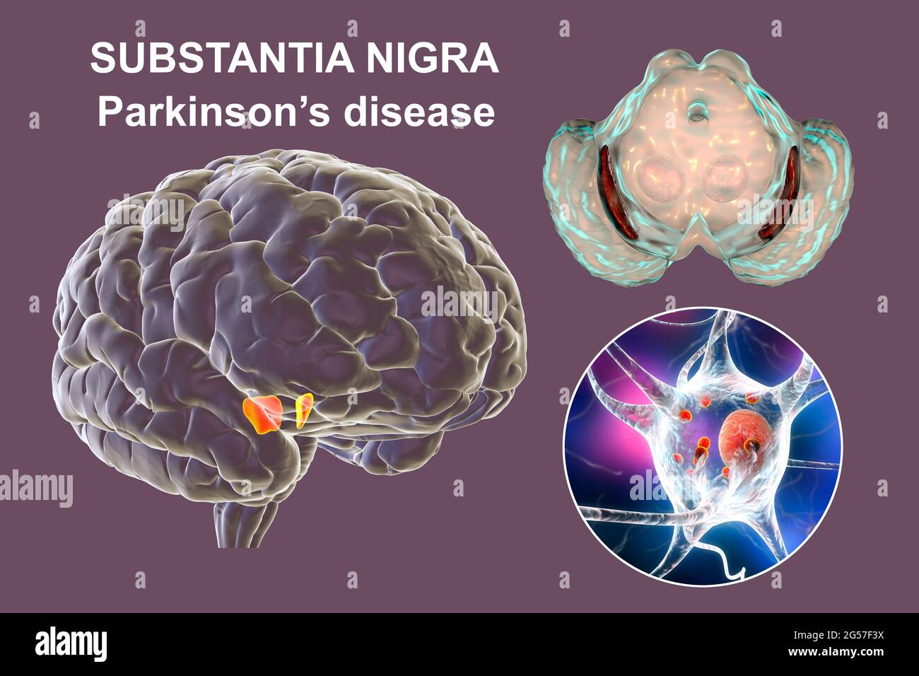 Substantia nigra in Parkinson's disease, illustration Stock Photo - Alamy