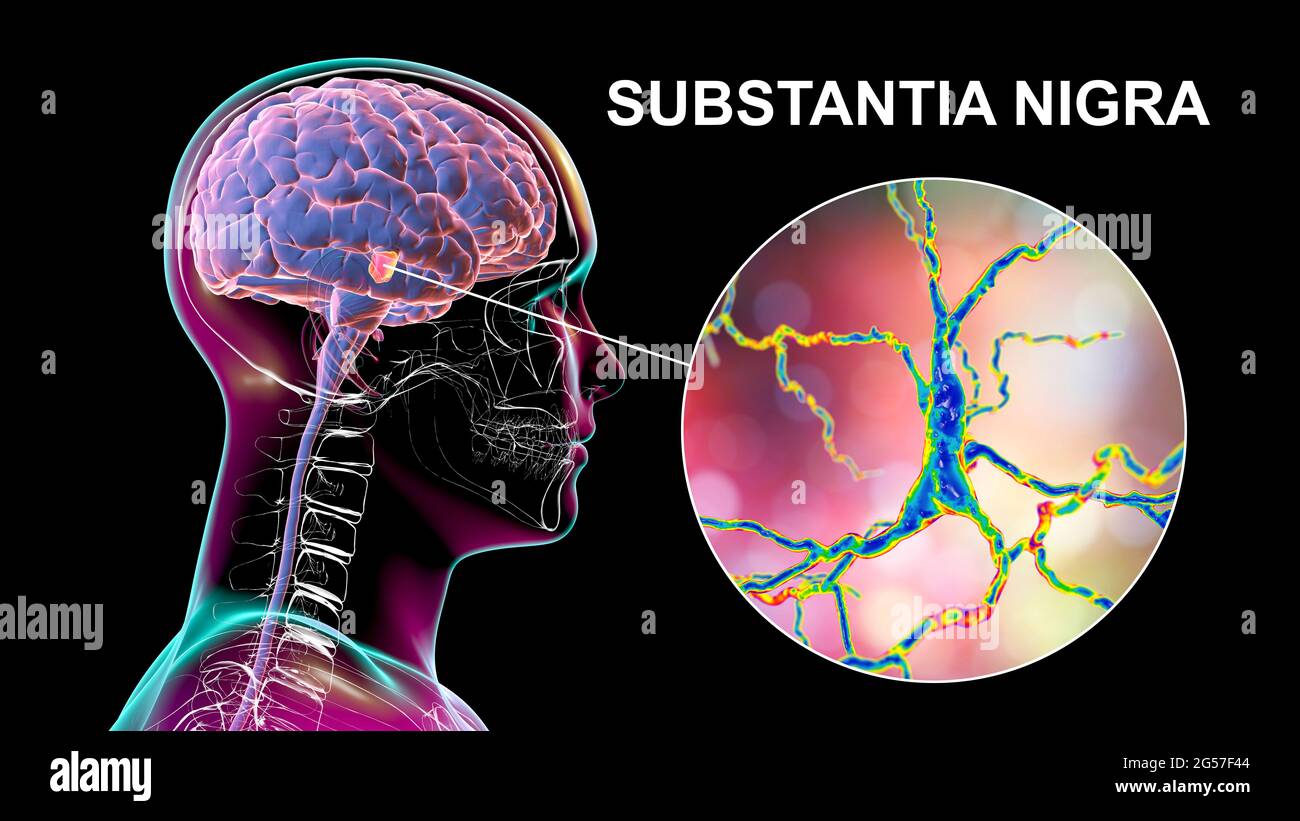 Normal and parkinson’s disease brain hi-res stock photography and ...