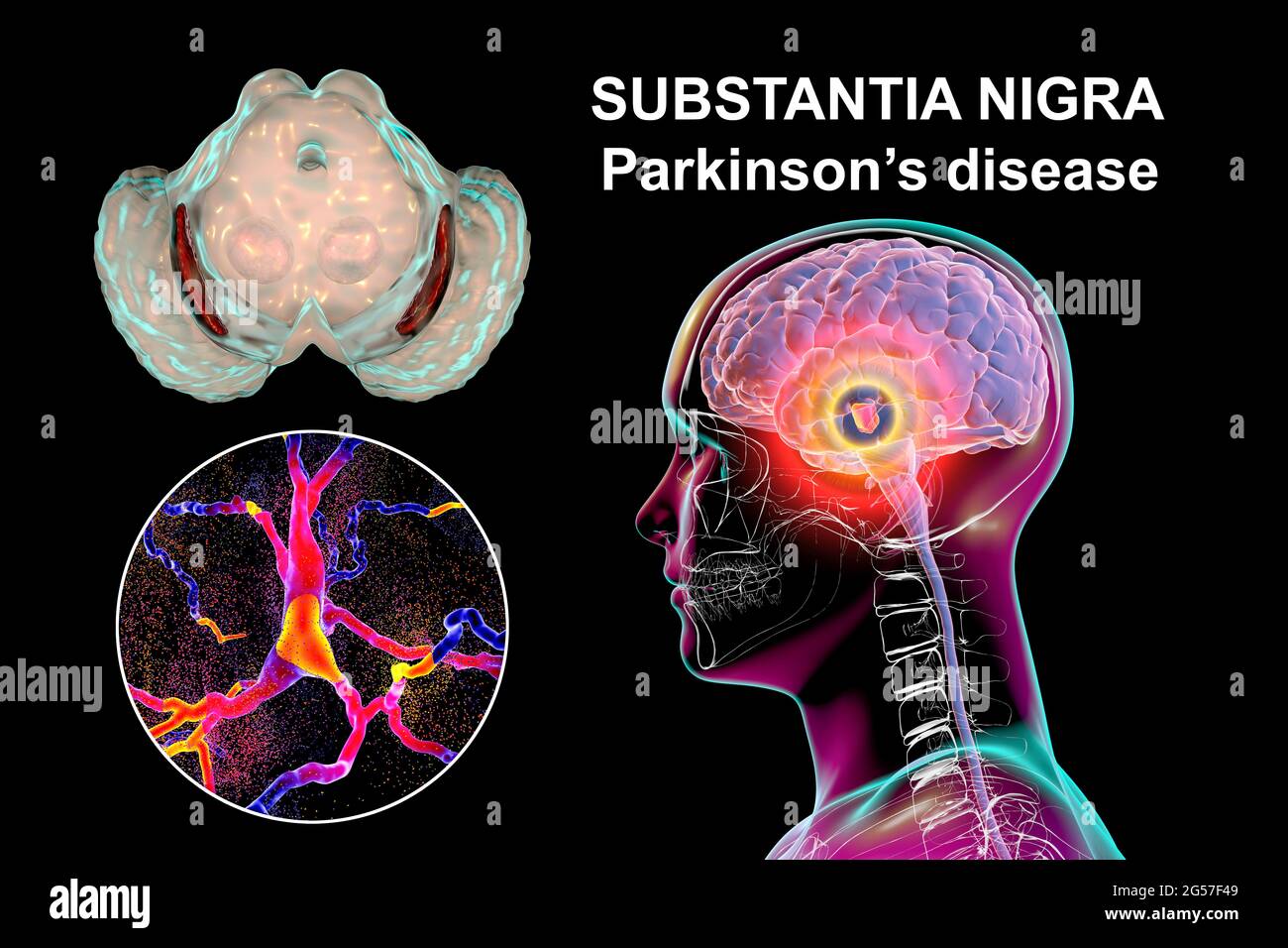 Parkinsons Disease Substantia Nigra