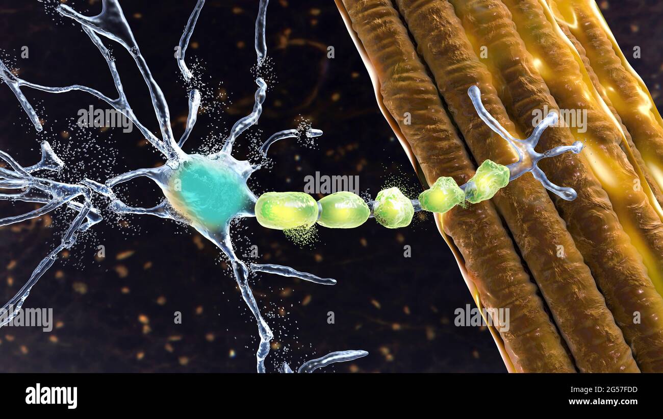 Degradation of motor neurons, illustration Stock Photo - Alamy