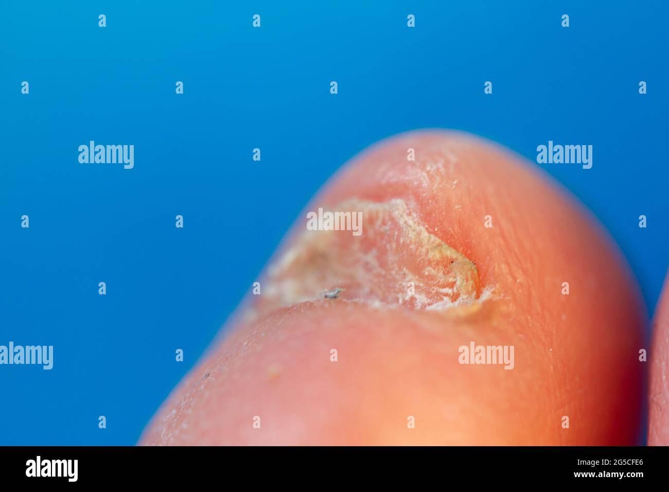 Big toe nail. Ugly nails Stock Photo - Alamy