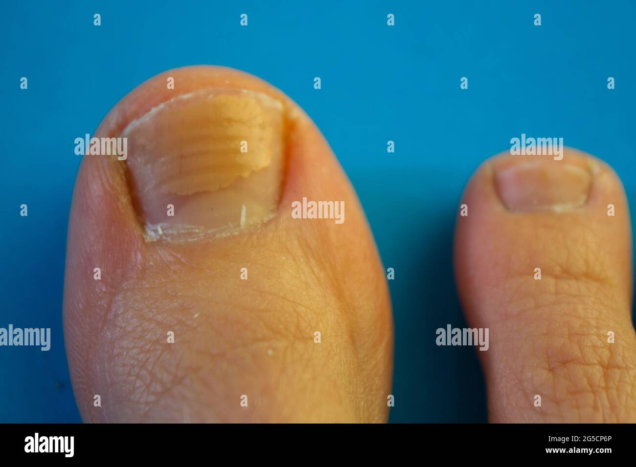 Big toe nail. Ugly nails Stock Photo - Alamy