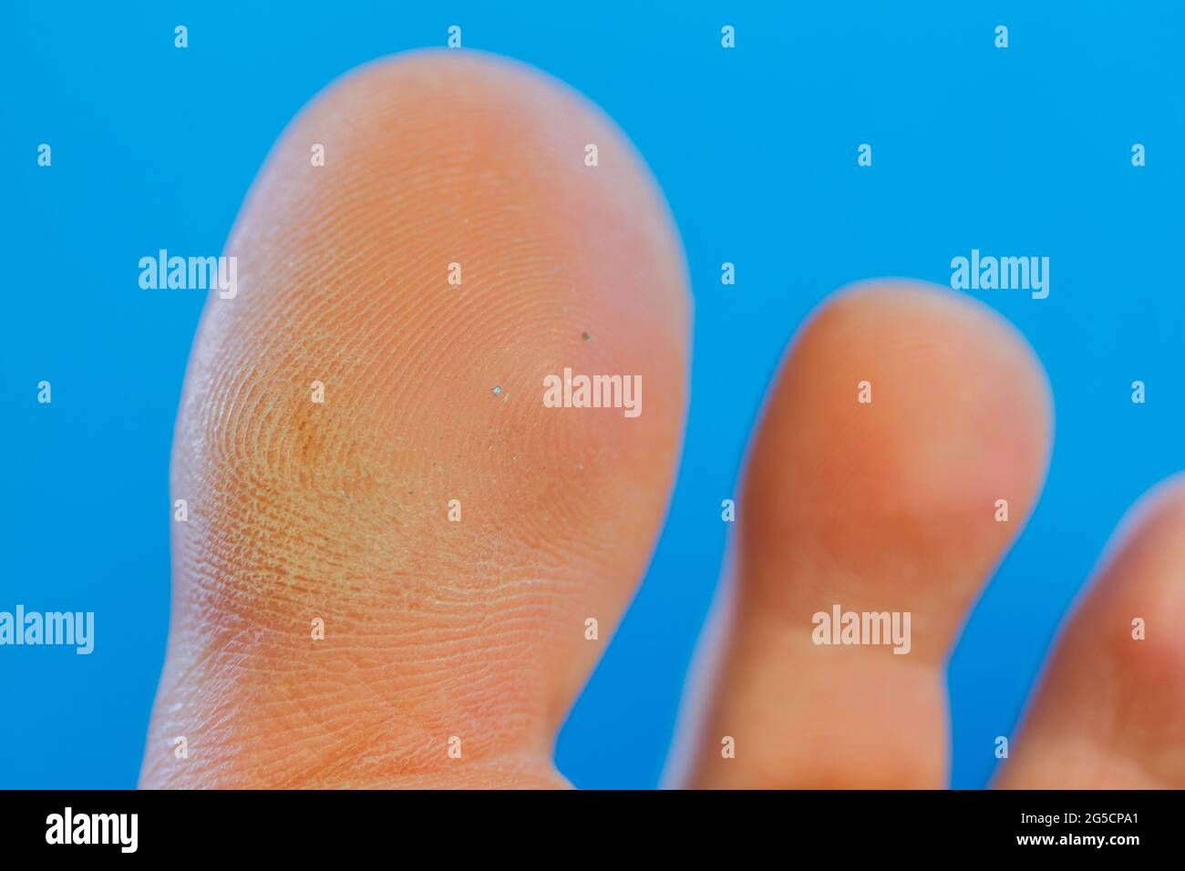 Close up of callus on a foot Stock Photo - Alamy