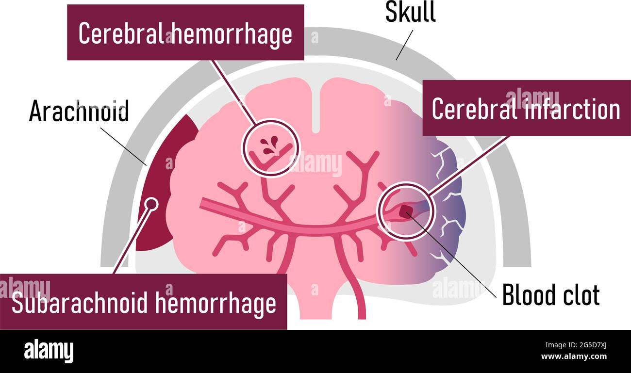 Types of human brain stroke vector illustration Stock Vector Image ...