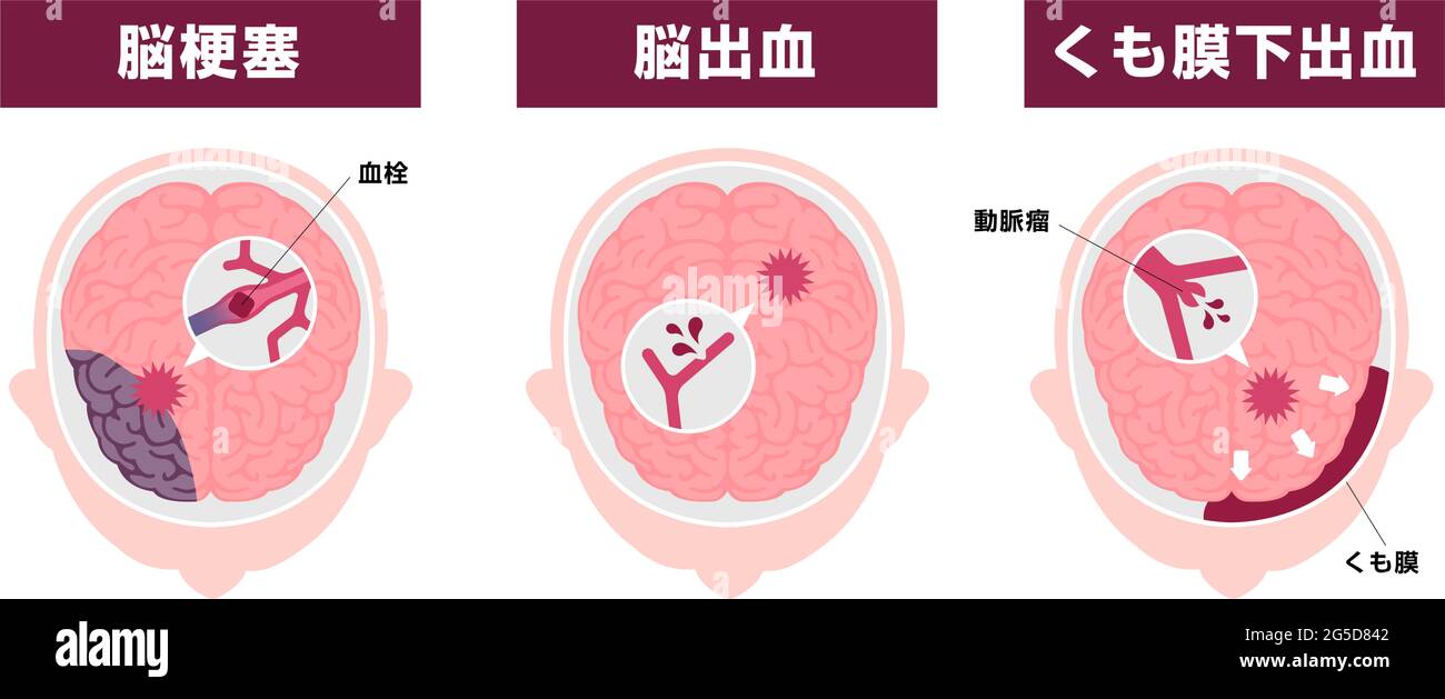 Types of human brain stroke vector illustration Stock Vector Image ...