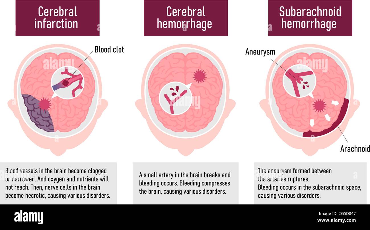 Types of human brain stroke vector illustration Stock Vector Image ...