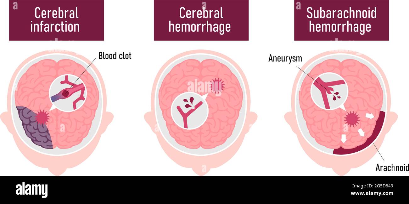 Brain stroke hi-res stock photography and images - Alamy