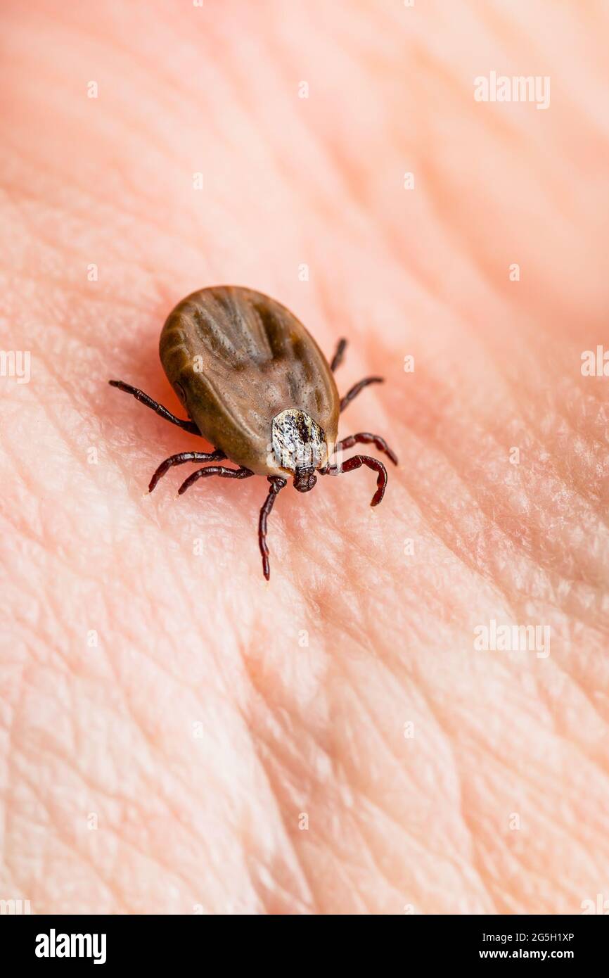 Encephalitis Infected Tick Insect Crawling on Skin. Lyme Borreliosis ...