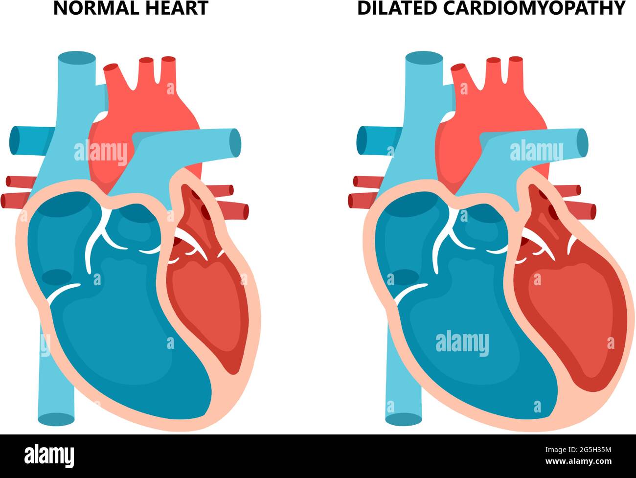 Dilated Cardiomyopathy With Cross Section View Human Heart Muscle
