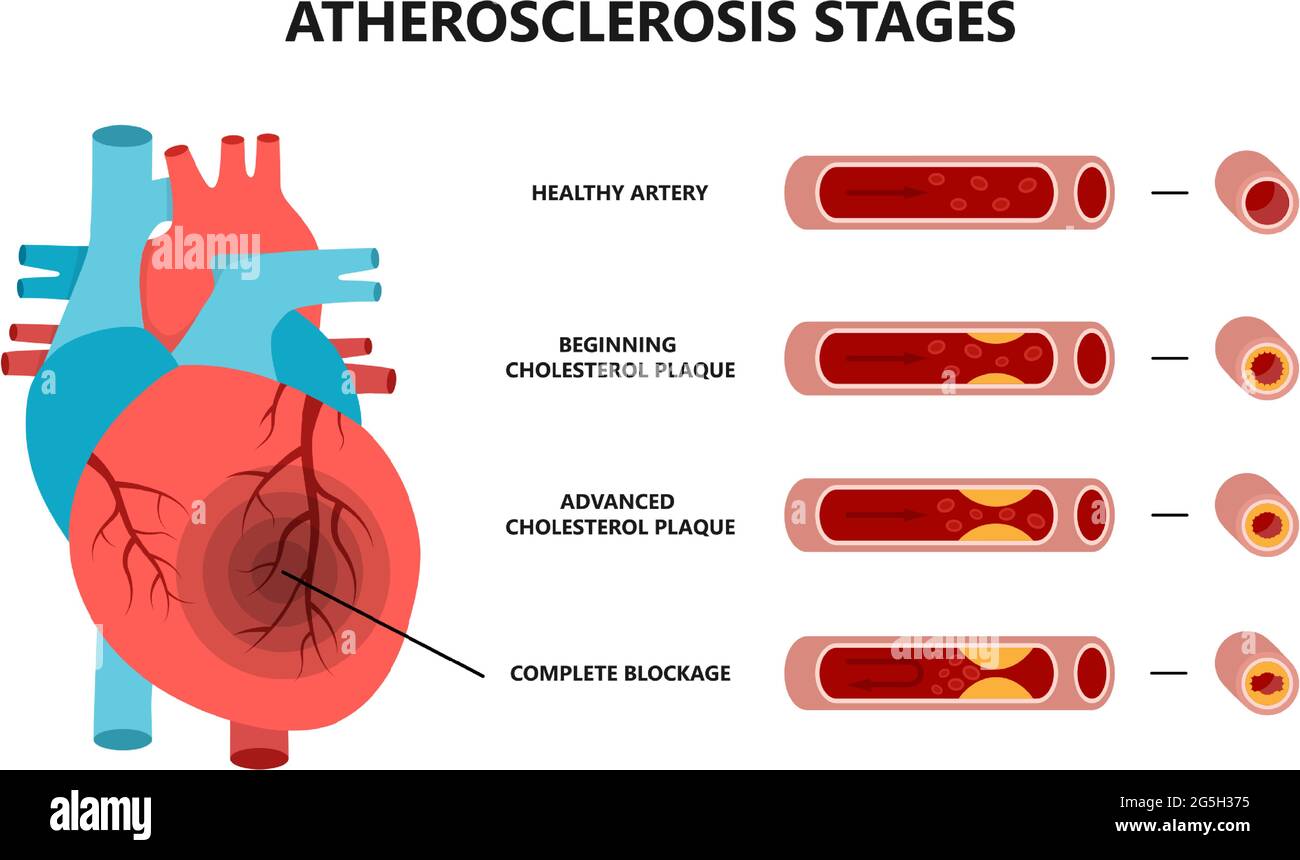 Arteriosclerosis surgery Stock Vector Images - Alamy