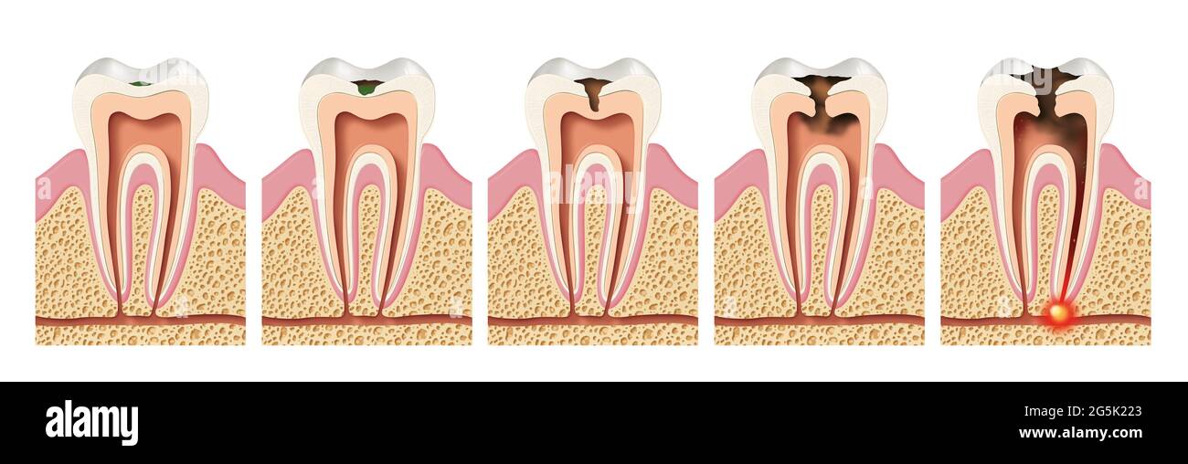 Stages of caries development. Periodontitis Stock Photo - Alamy