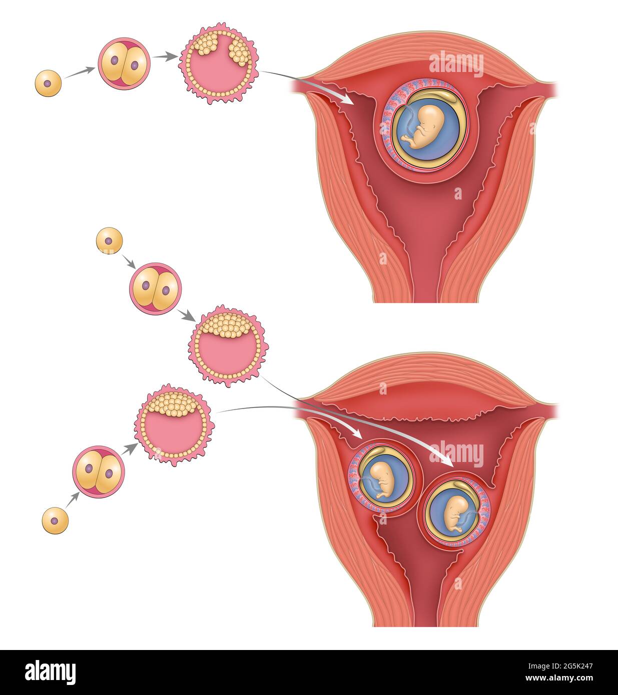Dizygotic and monozygotic human twins. Embryo Stock Photo - Alamy