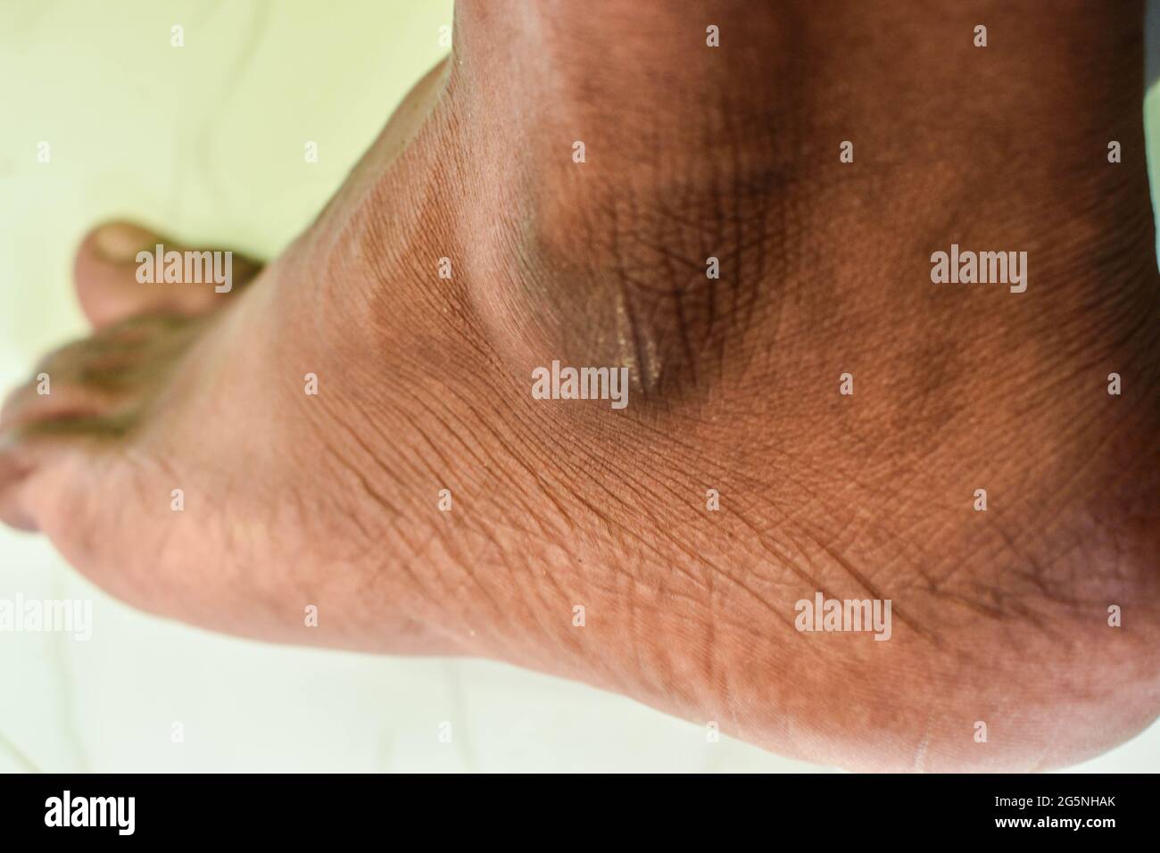 man's leg with black skin on ankle Stock Photo - Alamy