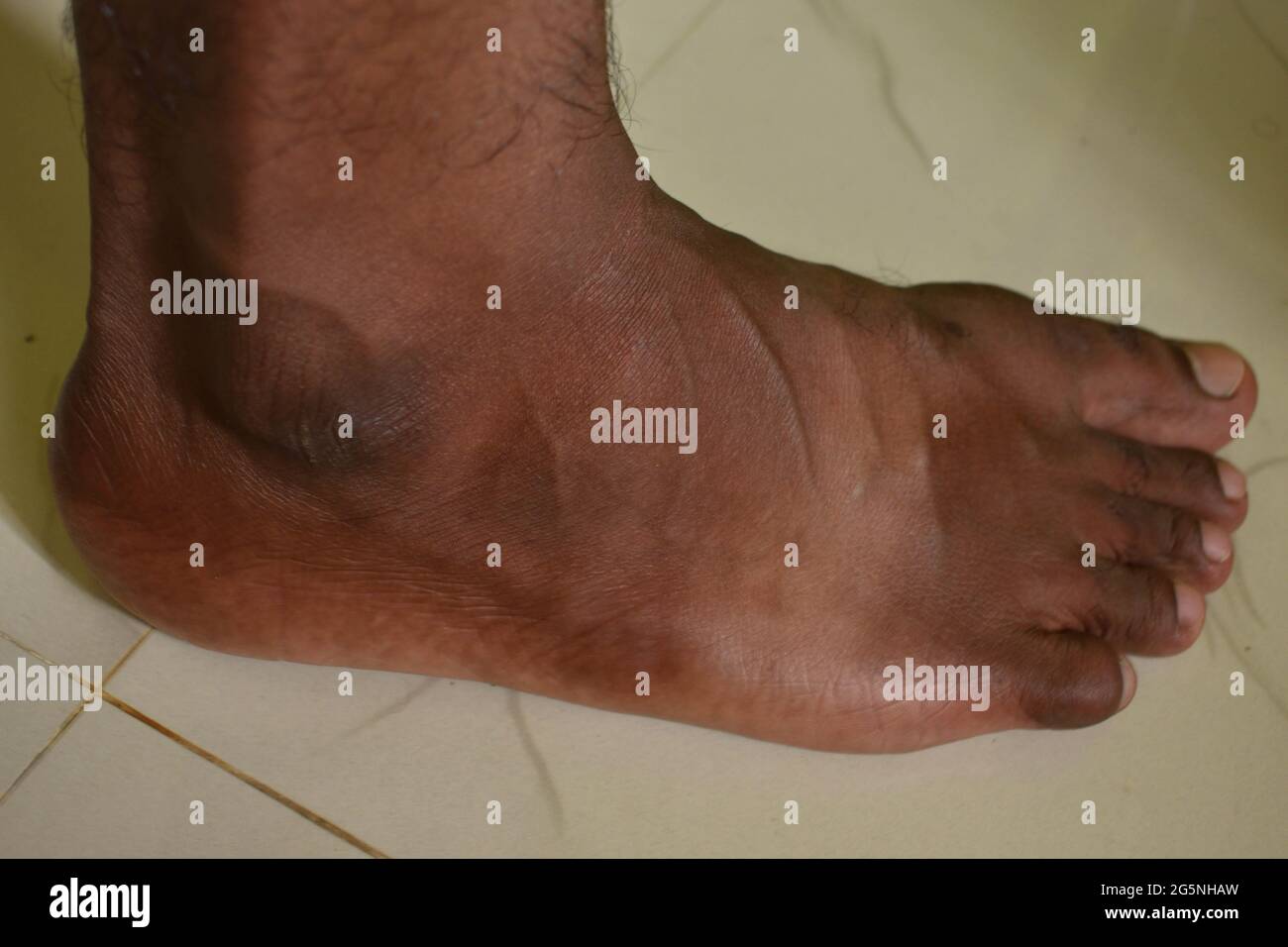 man's leg with black skin on ankle Stock Photo - Alamy