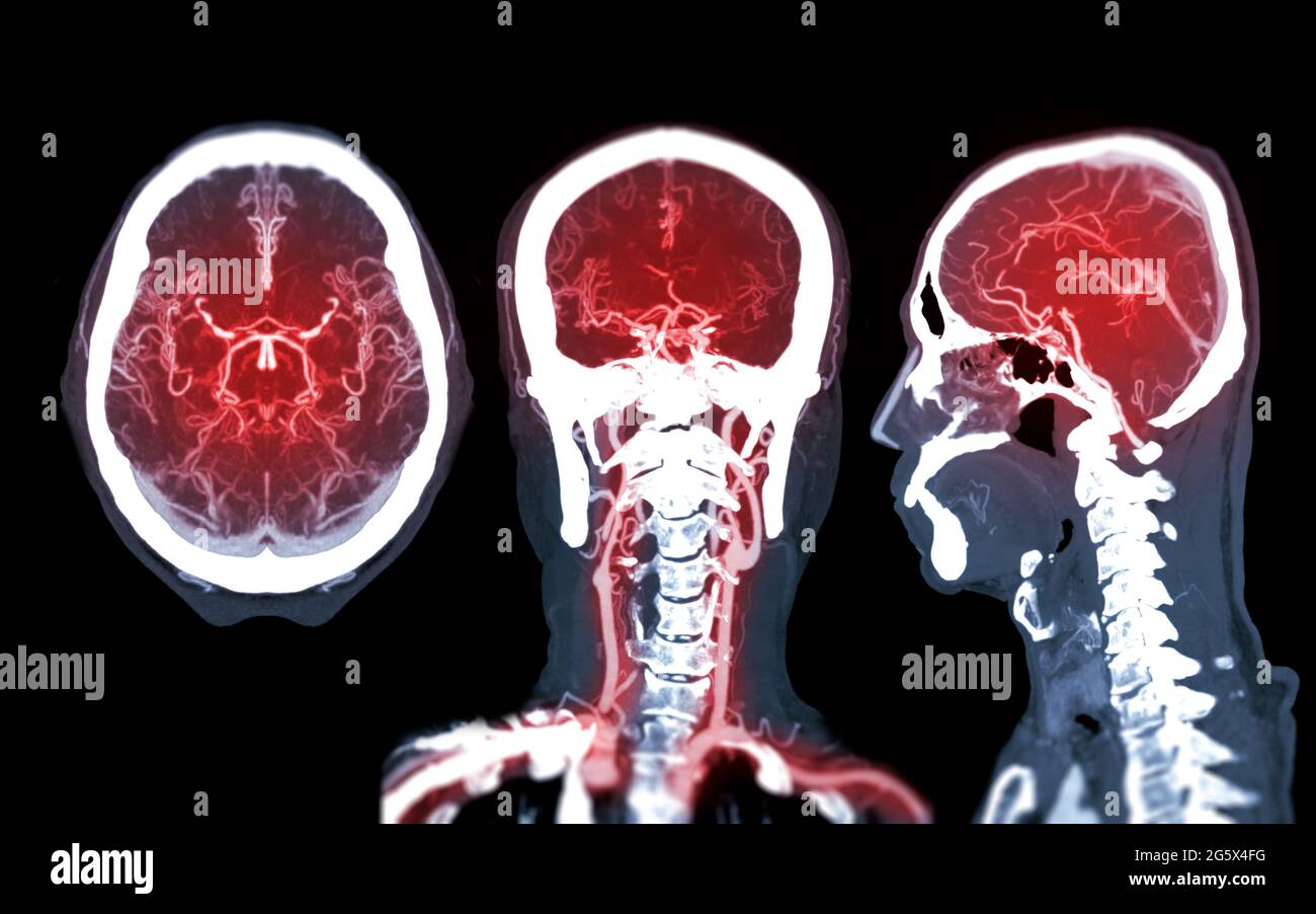Collection of CTA brain or CT angiography of the brain comparison Mip ...