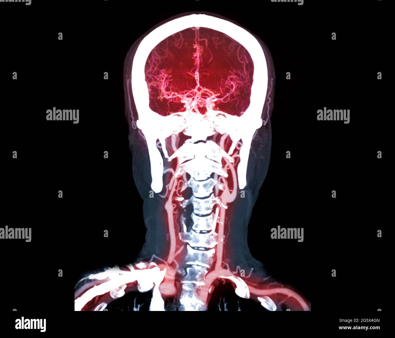 Collection of CTA brain or CT angiography of the brain comparison Mip ...
