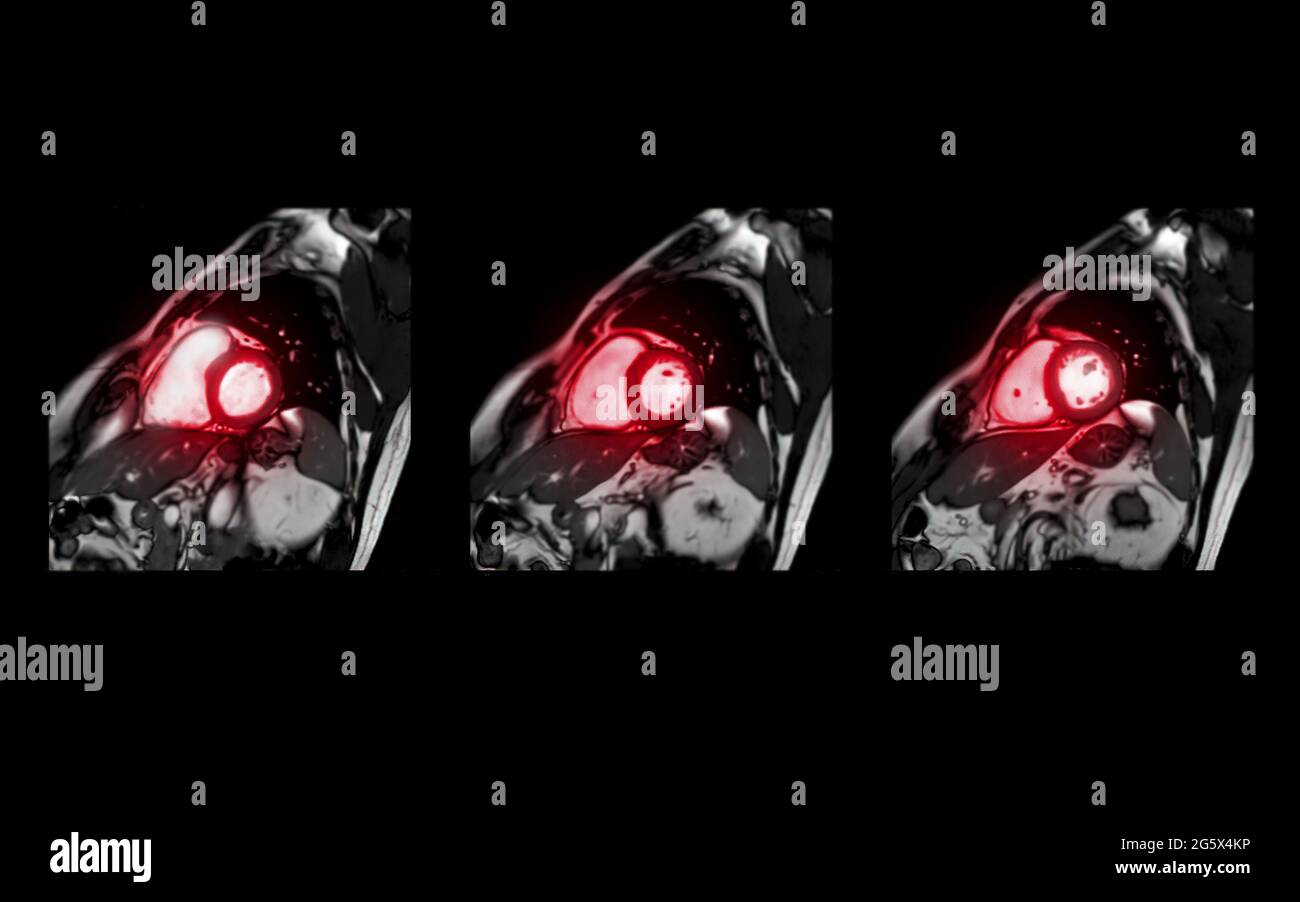 MRI heart or Cardiac MRI magnetic resonance imaging of heart in short ...