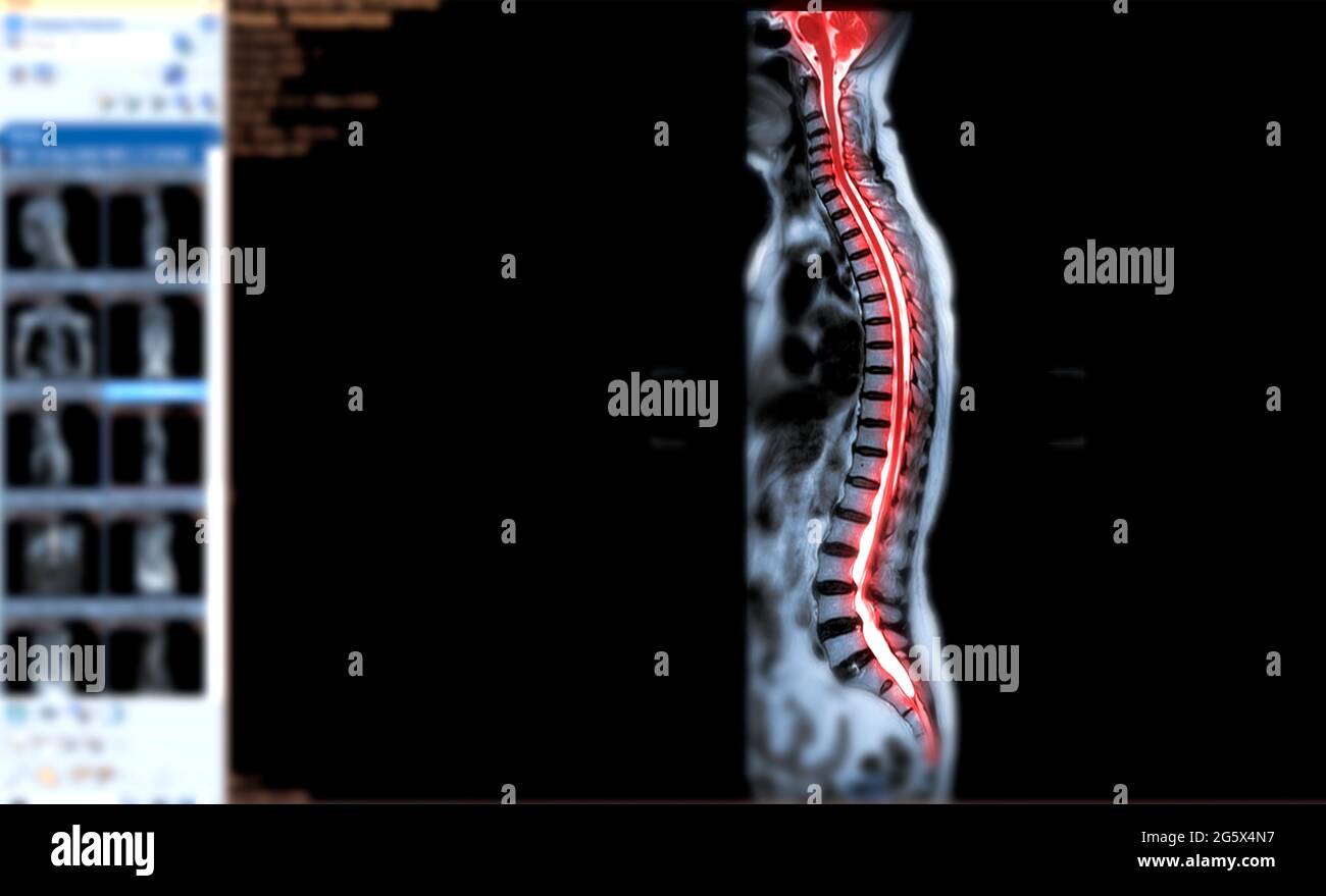 MRI of whole spine T2W sagittal plane for diagnostic Spinal Cord ...