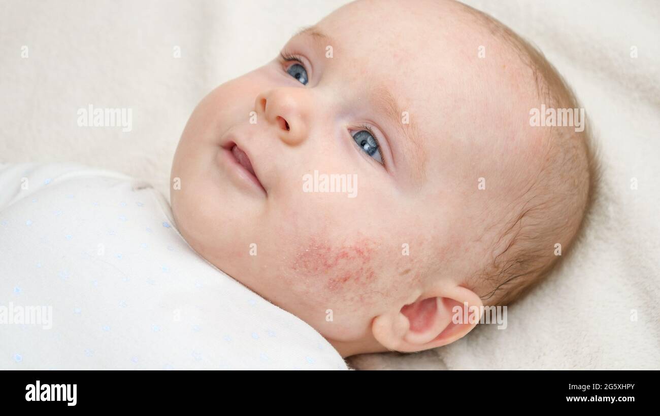 Portrait of cute little baby with red skin suffering from acne or ...