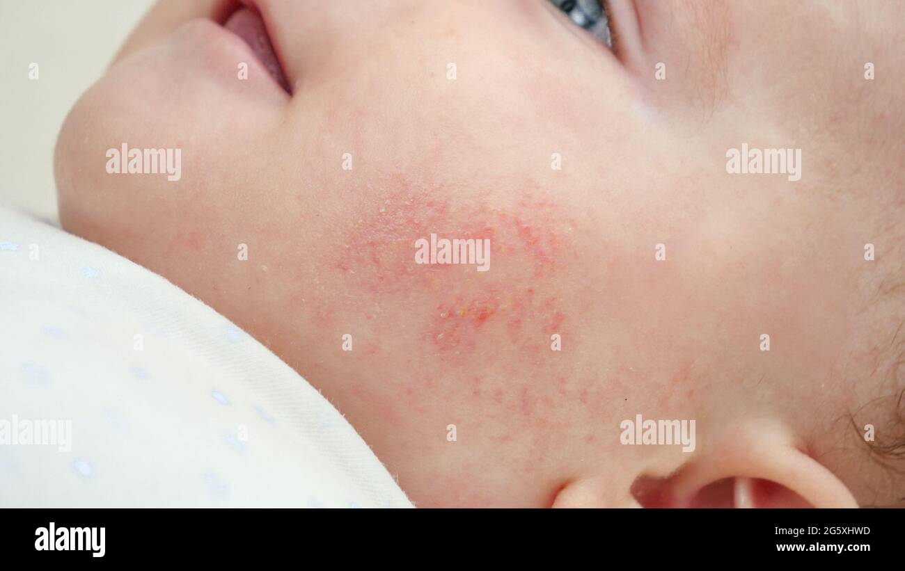 Closeup of baby face with red skin suffering from acne and dermatitis ...