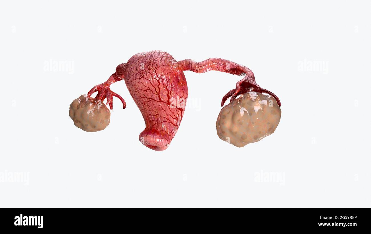 Cervicitis hi-res stock photography and images - Alamy