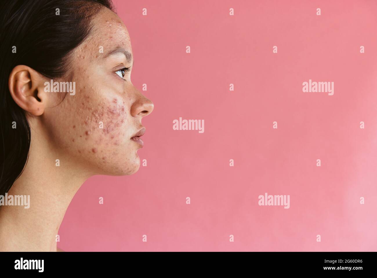Side view portrait of a woman having acne inflammation. Close up of a ...