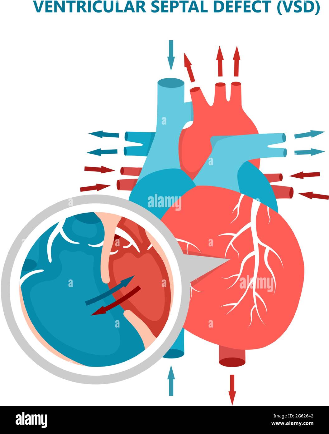 Ventricular septal defect VSD with heart blood flow. Human heart muscle ...