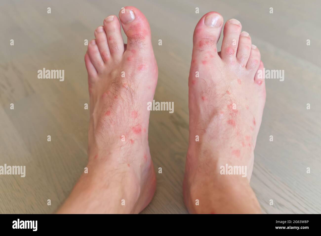 close up on many mosquito bites on men's foot skin Stock Photo - Alamy