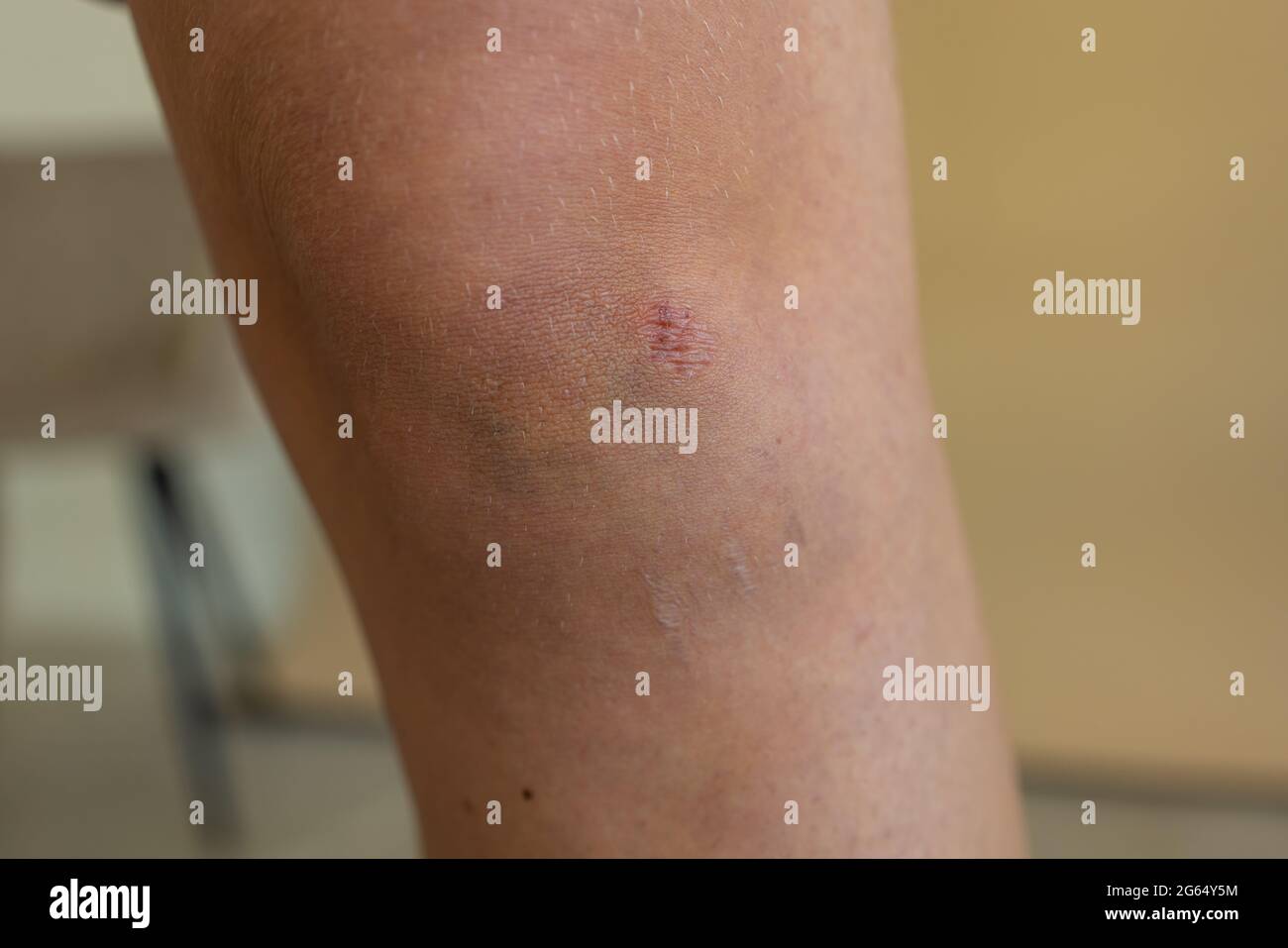 Knee pain cream hi-res stock photography and images - Alamy