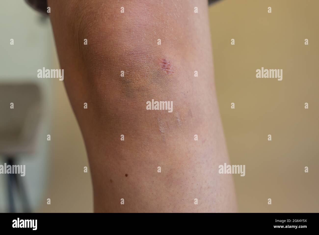 Abrasion on the woman's knee. Injured leg with a red wound. Medical ...