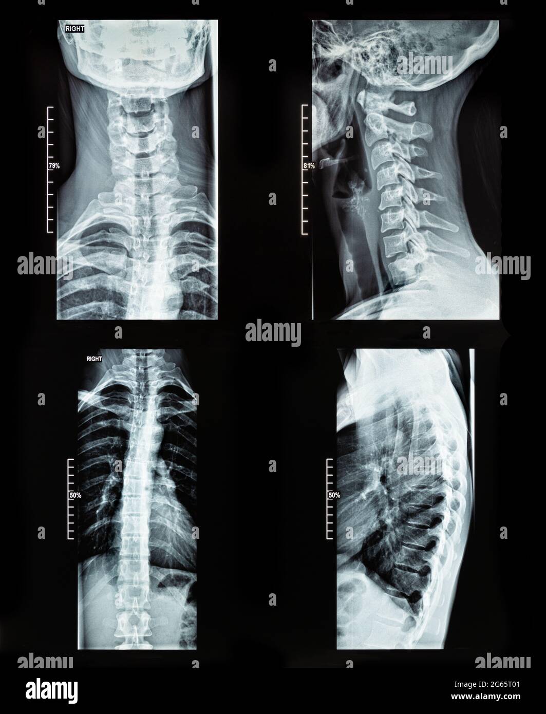 Mri lumbar spine coronal hi-res stock photography and images - Alamy