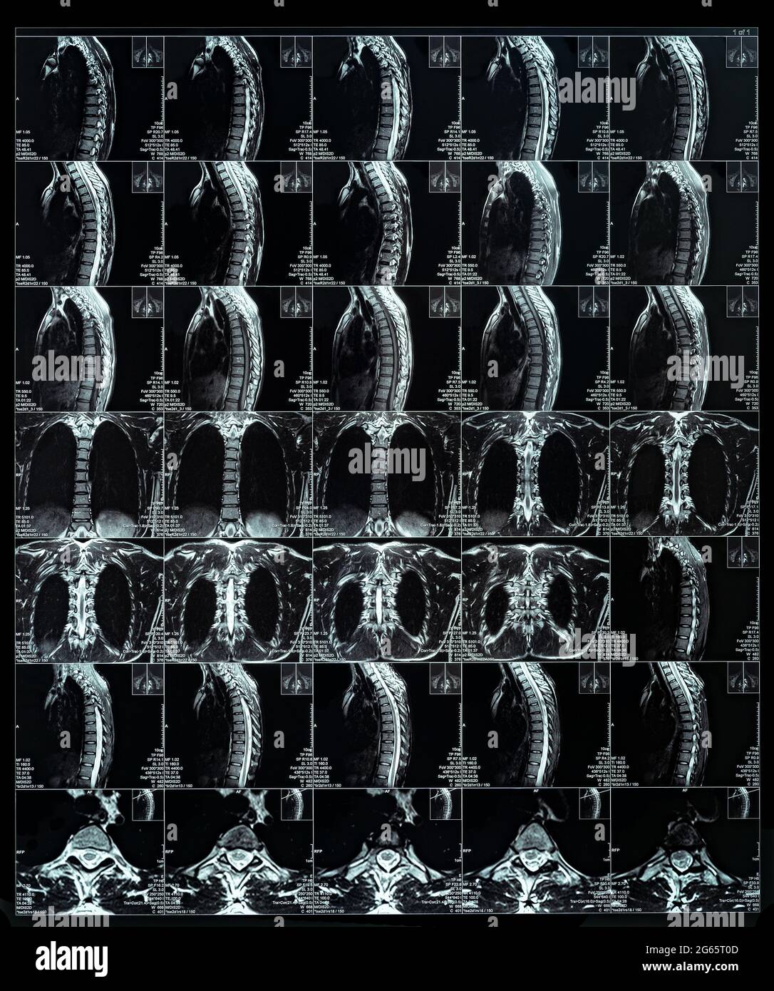 Spinal curve hi-res stock photography and images - Alamy
