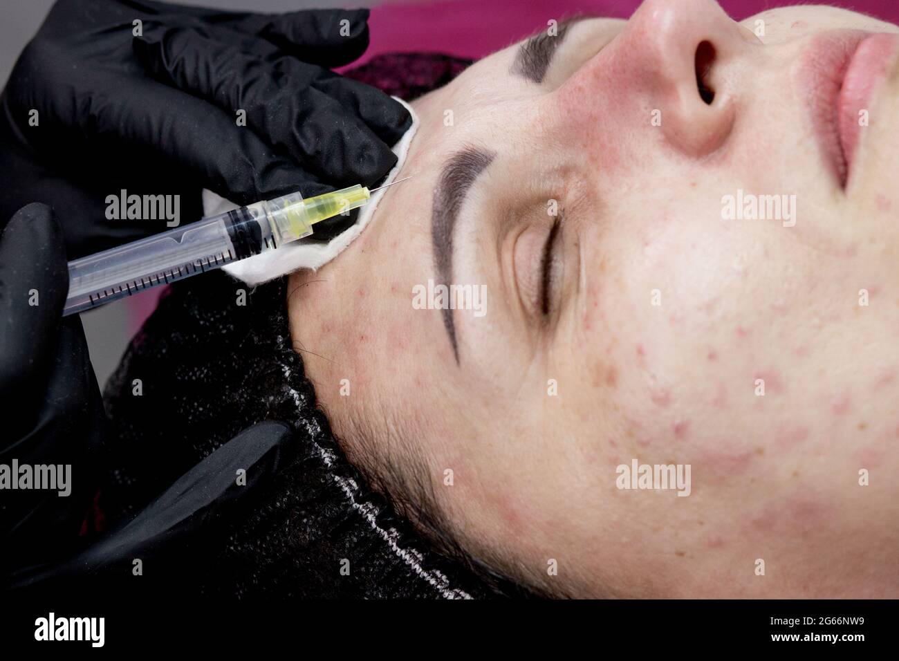 Cosmetologist doctor is making multiple injections biorevitalization ...