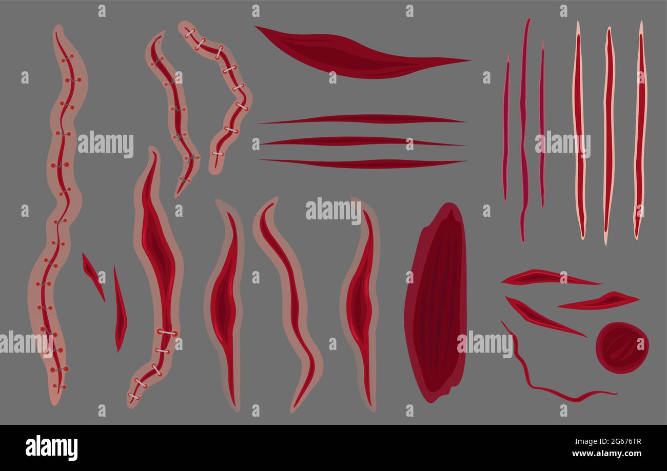 Vector illustration set of stitches, scars on grey background. Bruise ...
