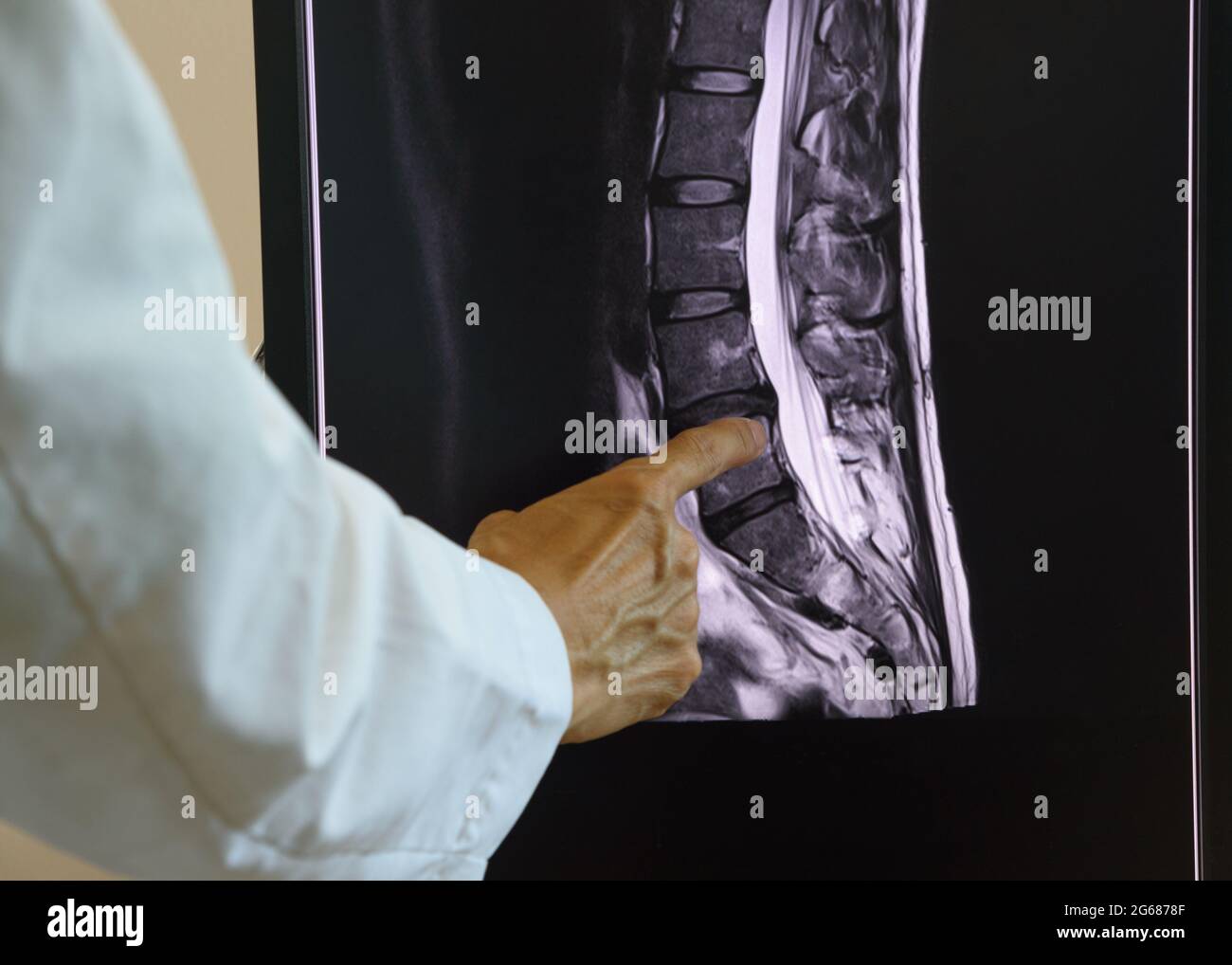 Lumbar vertebra lateral hi-res stock photography and images - Alamy